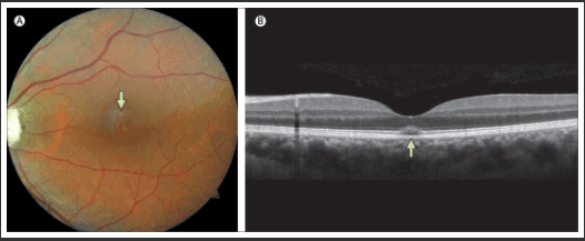 These Are Your Eyes on Drugs: "Poppers Maculopathy"