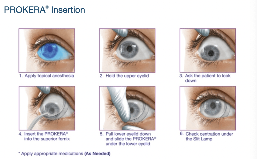 Treating Ocular Surface Disease with Amniotic Membranes