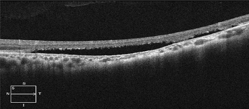 Distinguishing Torpedo Maculopathy with OCT