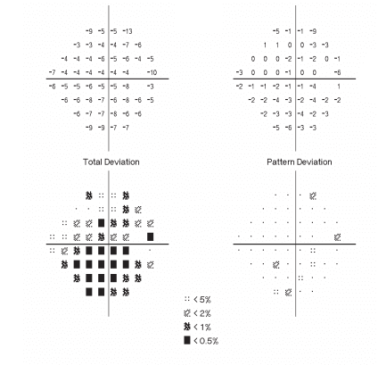 An Optometrist’s Refresher on Visual Field Indices