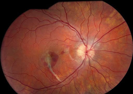 Differential Diagnosis for a Pigmented Fundus Lesion with Downloadable ...
