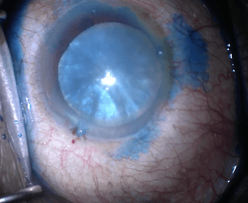 Case Report: The Challenges of White Cataracts