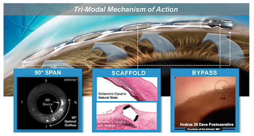 Here’s When and Why I Use Each of These MIGS Devices