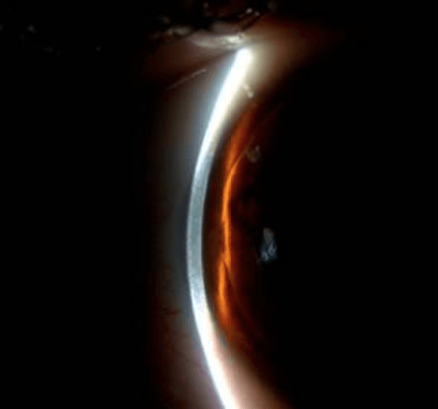 How to Co-Manage Narrow Angle Patients with an Ophthalmologist (with ...